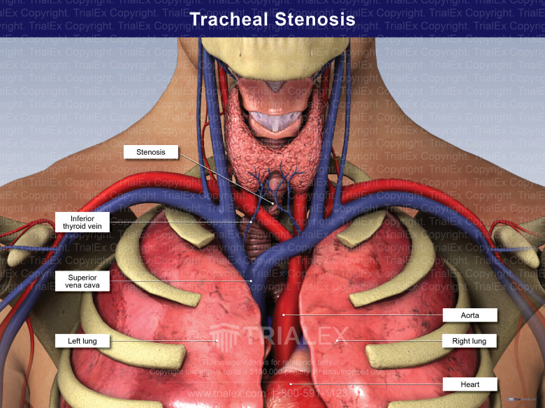 Tracheal Stenosis - TrialExhibits Inc.