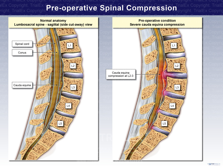 Spinal Cord Compression