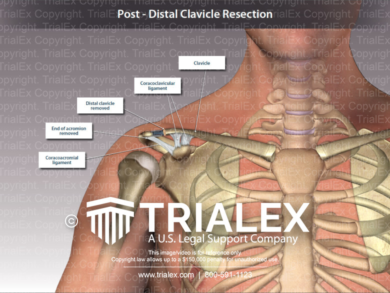 Post-Distal Clavicle Resection - TrialExhibits Inc.