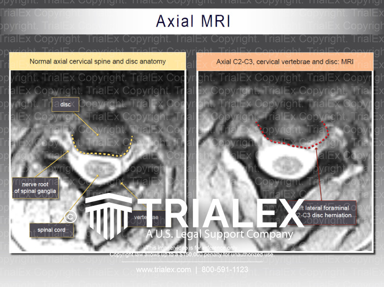 Axial MRI - TrialExhibits Inc.