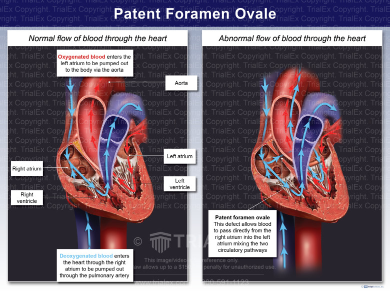 Patent Foramen Ovale - TrialExhibits Inc.
