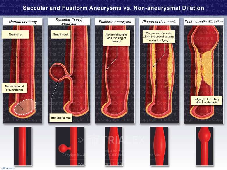 Saccular And Fusiform Aneurysms Vs Non Aneurysmal Dilation Trialexhibits Inc