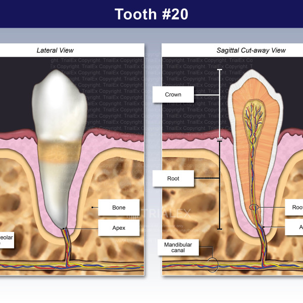 Tooth #20 - TrialExhibits Inc.