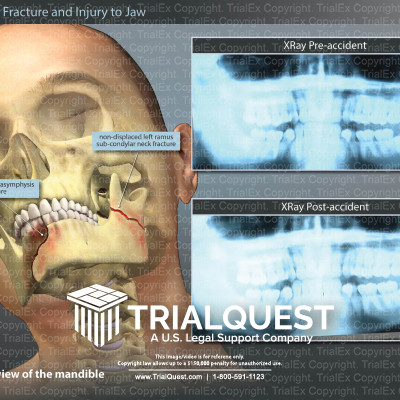 Traumatic Fracture and Injury to the Jaw - TrialExhibits Inc.